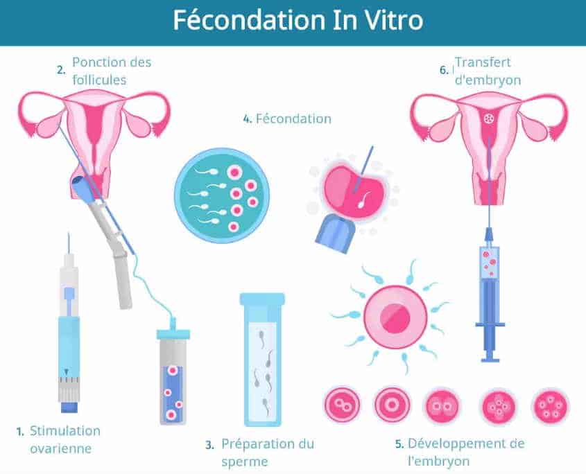 La FIV ou fécondation in vitro